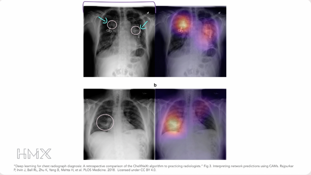 AI in Medicine: Medical Image Interpretation | Harvard University